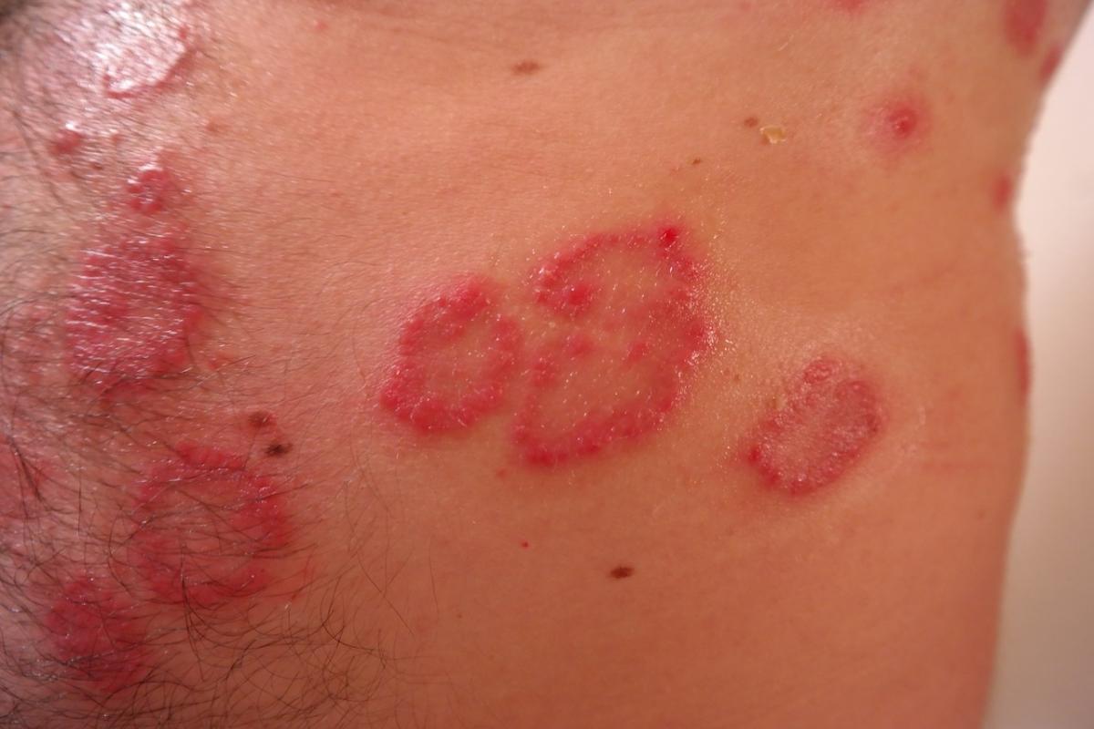 Traitements systémiques du psoriasis en plaques modéré à sévère ...